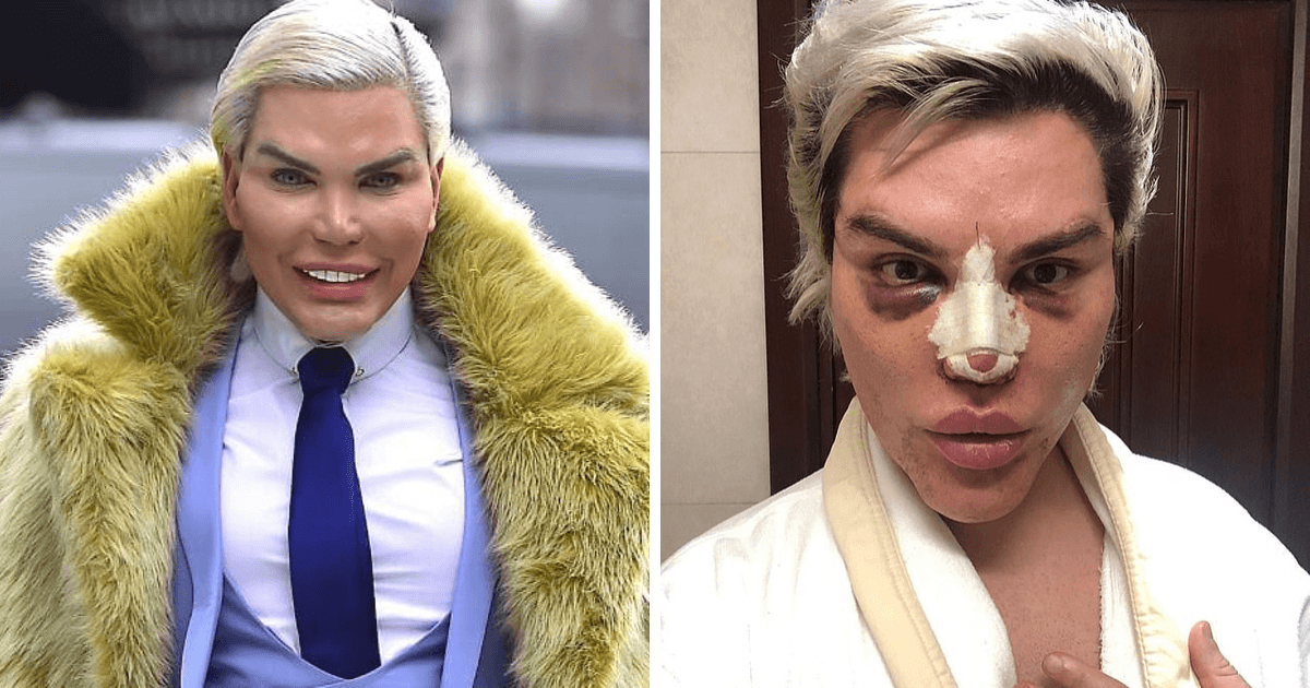 Human Ken Doll's Nose Is Collapsing So He's Having Another Surgery